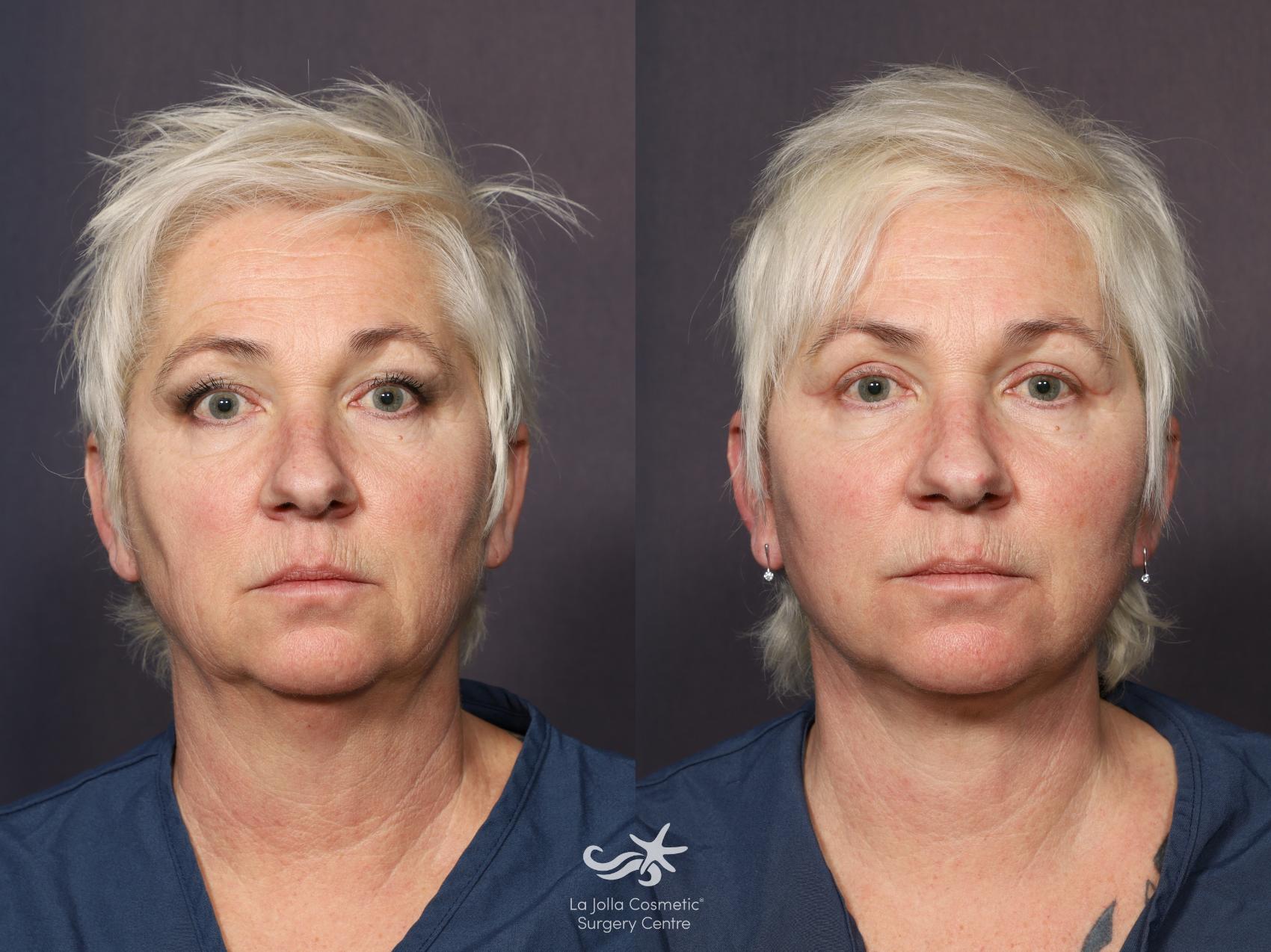 T-Z Plasty, Neck Lift & Rejuvenation in San Diego, CA | La Jolla ...