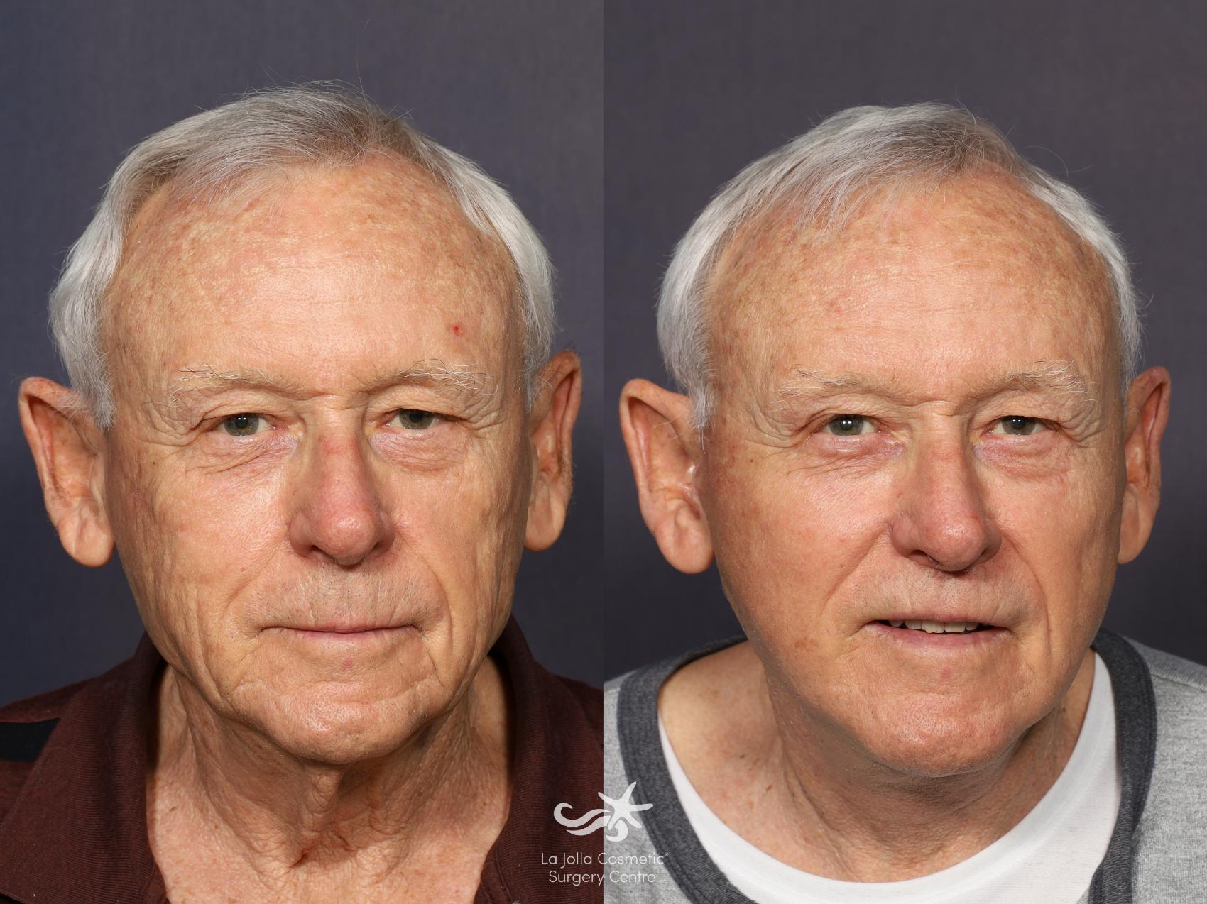 T-Z Plasty, Neck Lift & Rejuvenation in San Diego, CA | La Jolla ...