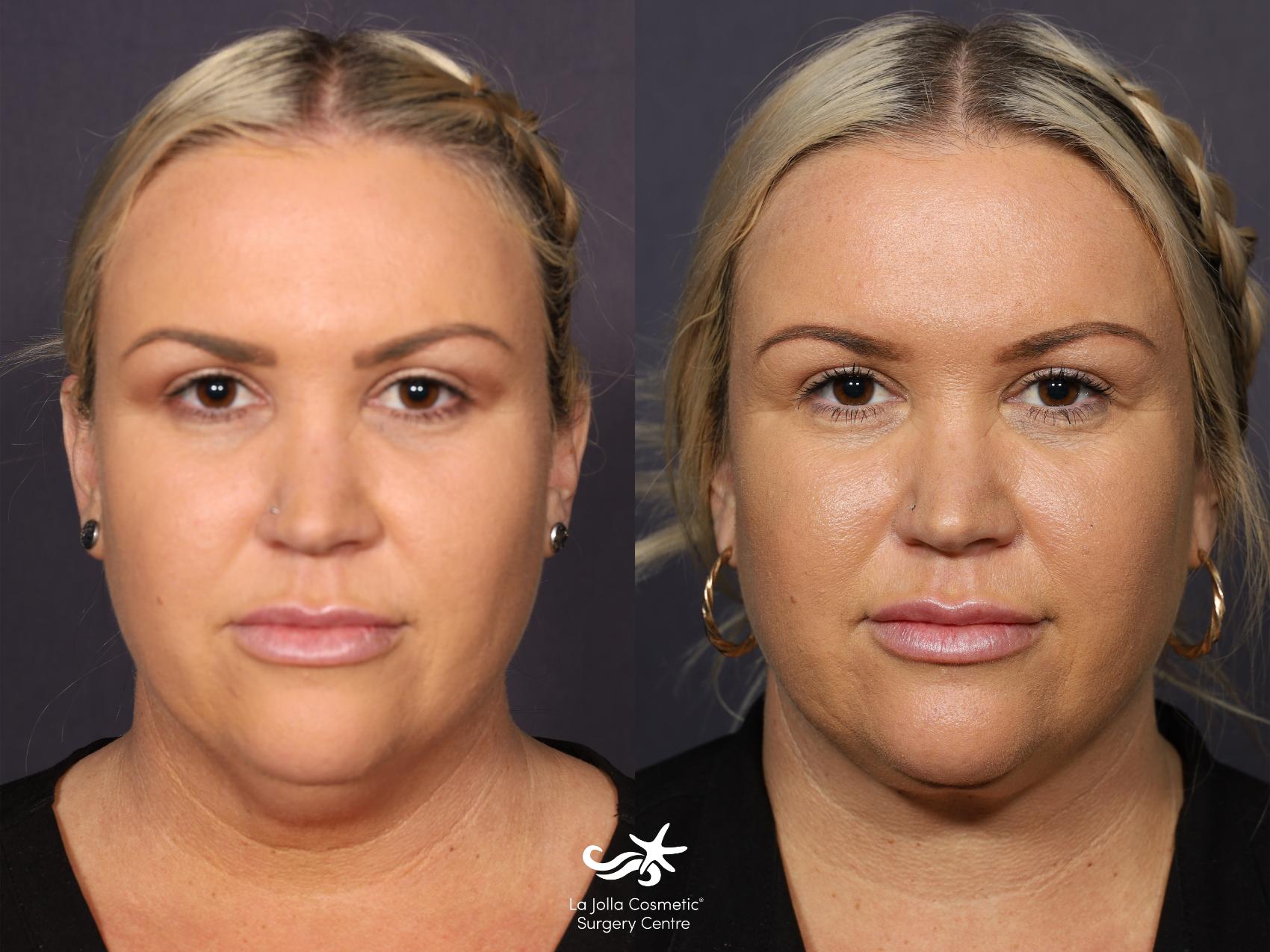 Neck Liposuction Before and After Pictures Result 729 | San Diego, CA ...