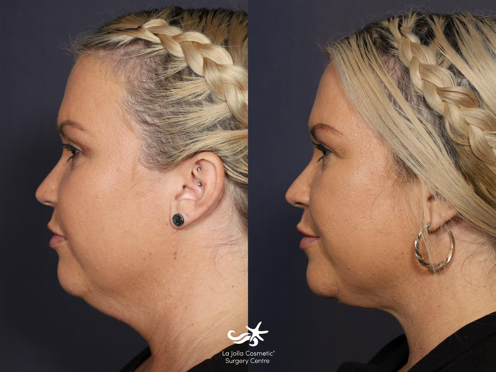 Neck Liposuction Before and After Pictures Result 729 | San Diego, CA ...