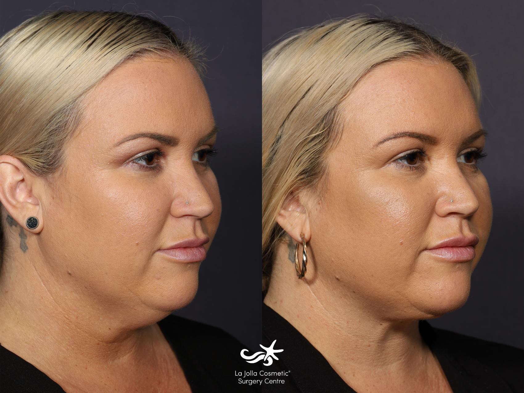 Neck Liposuction Before and After Pictures Result 729 | San Diego, CA ...