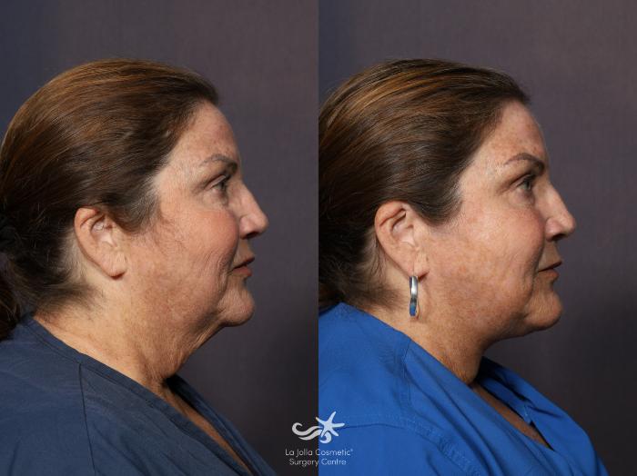 Z Plasty Before And After